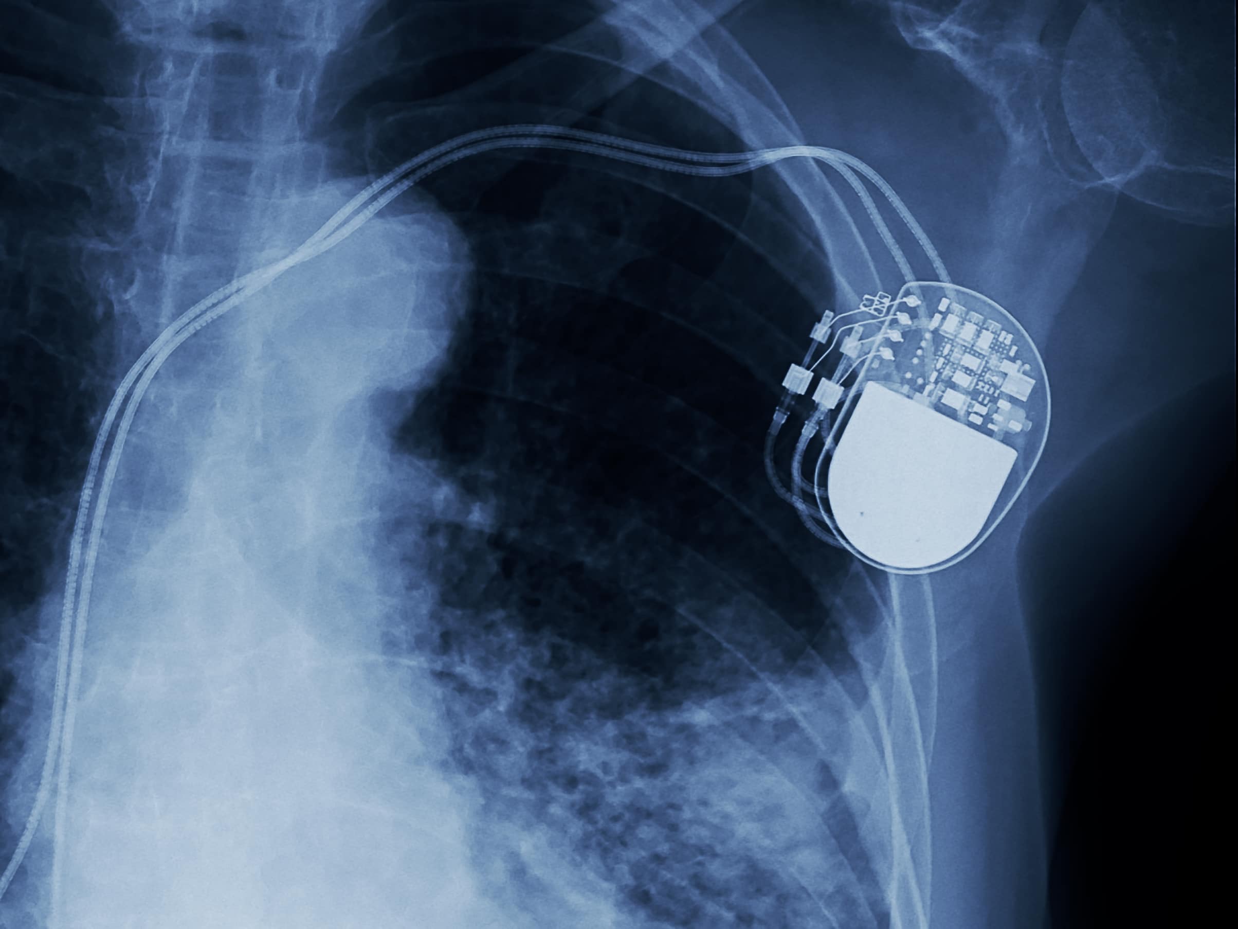 Breathable Electronic Skins – Dissolvable Pacemakers – Flying AEDs ...