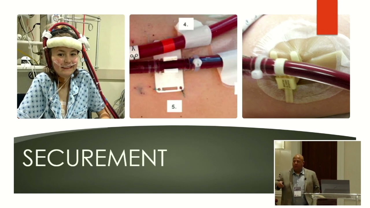 ECMO: What’s Your Center’s Strategy? Cannula, Patient, and Circuit Management - Perfusion.com